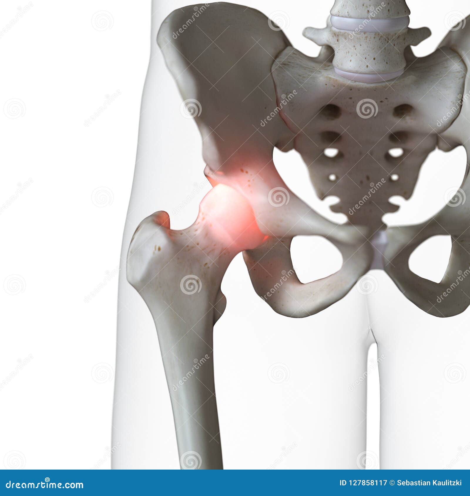 Une Articulation De La Hanche Douloureuse Illustration Stock ...