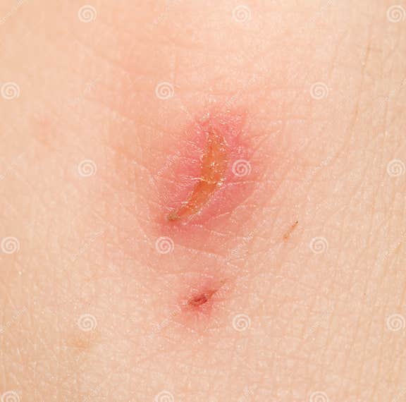 Une blessure sur la peau image stock. Image du blessures - 88013539