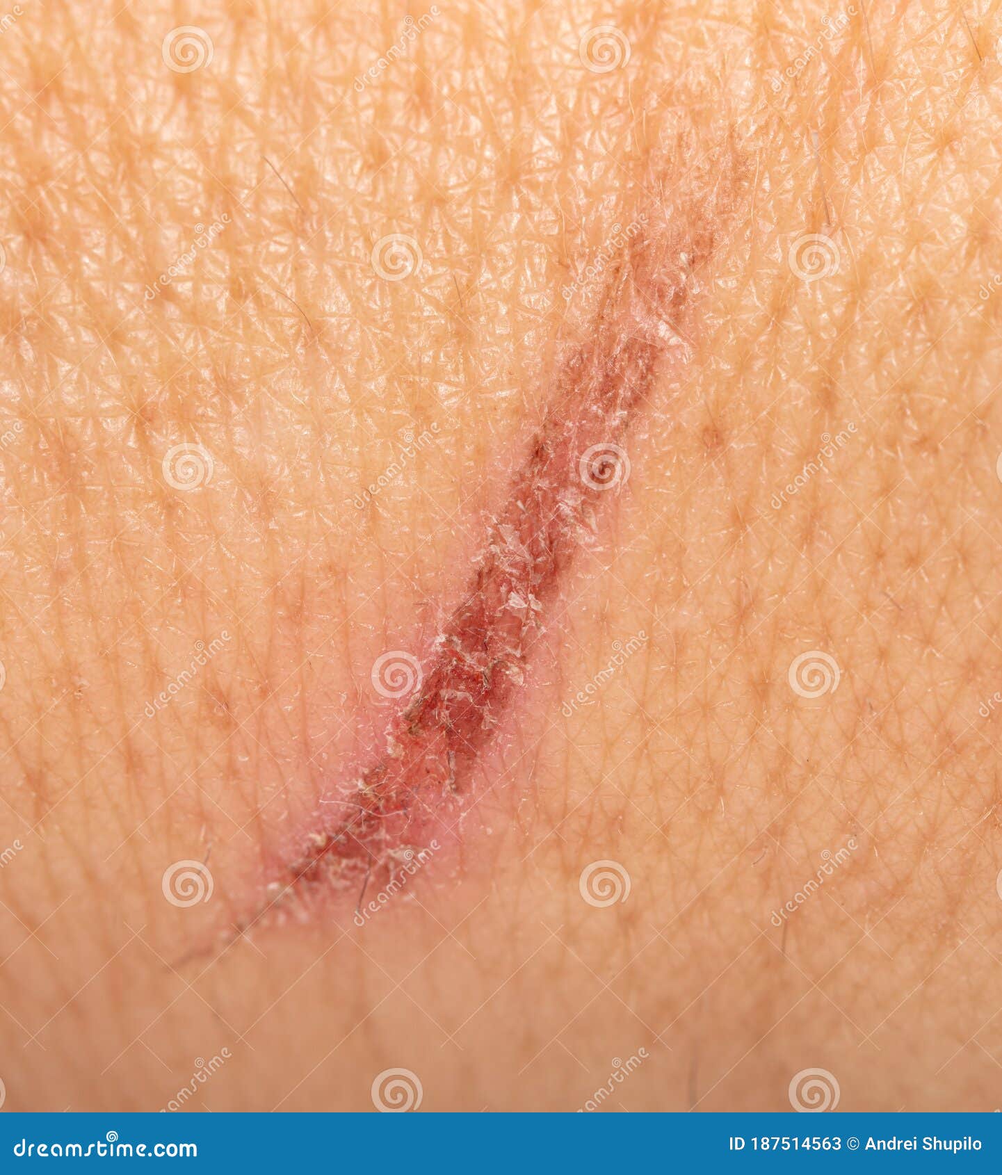 Une Blessure Sur La Peau D'une Personne Image stock - Image du ...