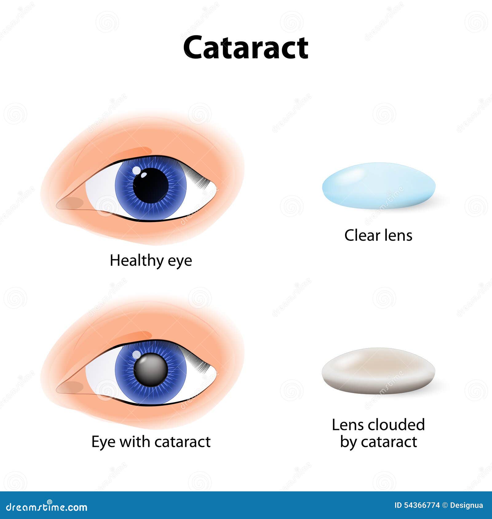 Une Cataracte Est Un Cristallin De Opacification Illustration de ...