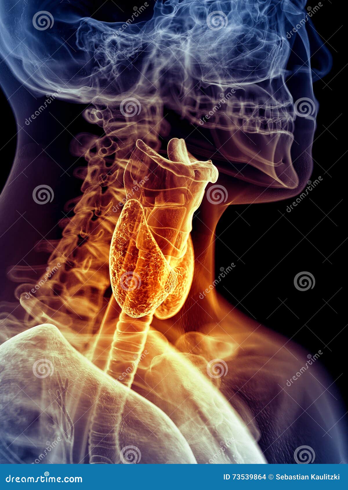 Une gorge enflammée illustration stock. Illustration du maladie - 73539864