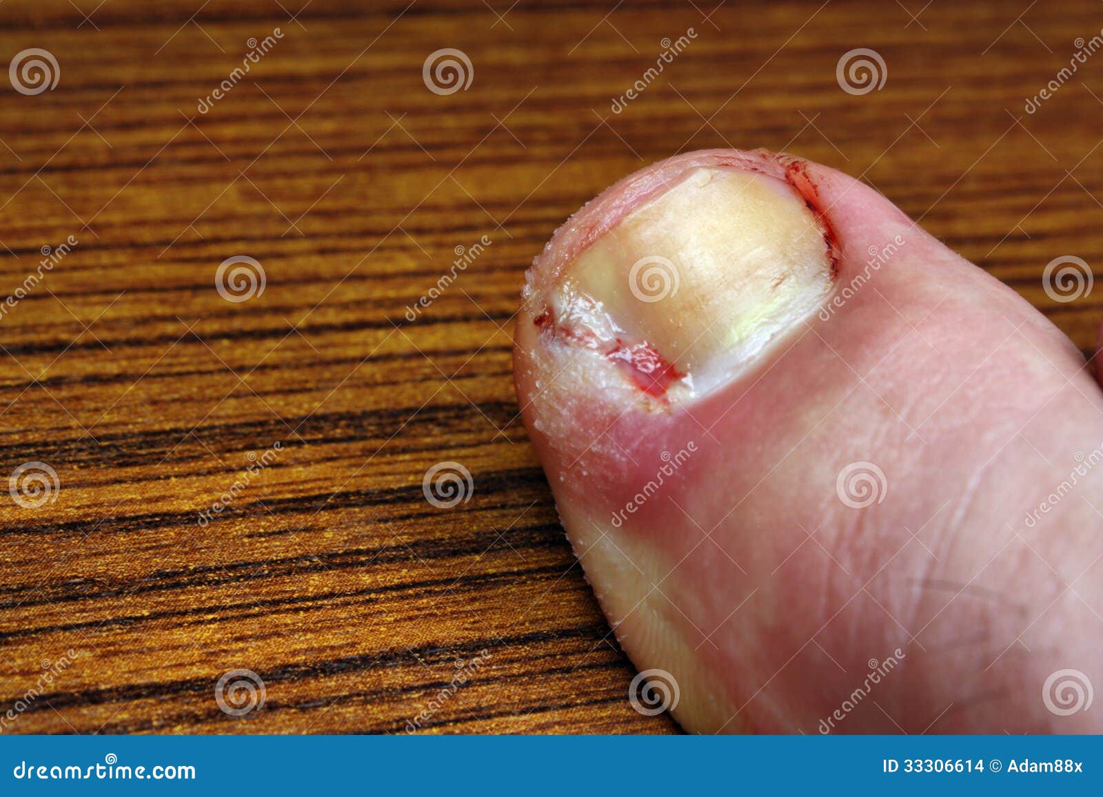 Unghia del piede fotografia stock. Immagine di incidente - 33306614