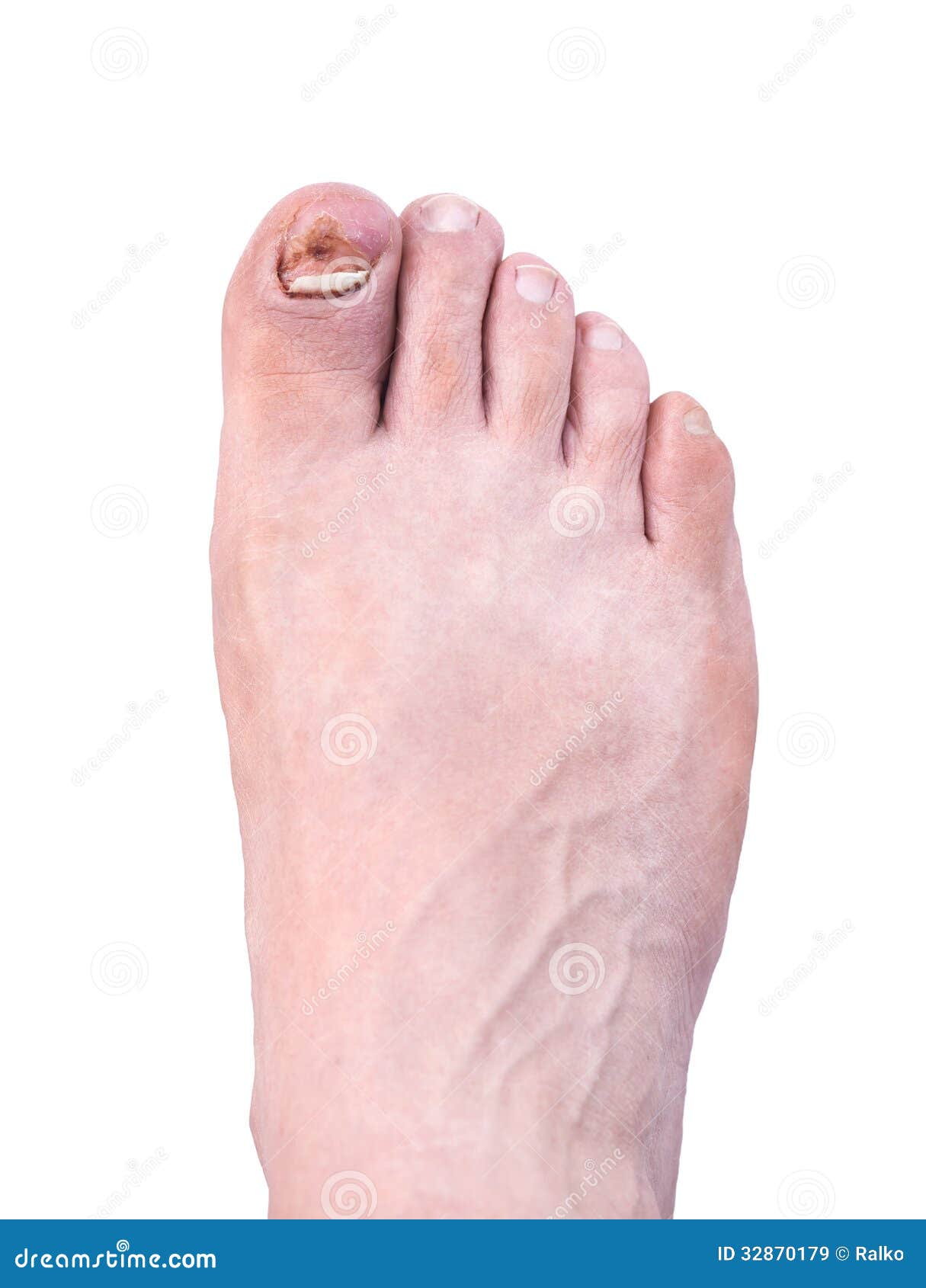 Unghia rotta immagine stock. Immagine di colpo, nomi - 32870179