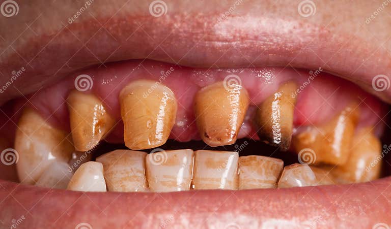 Unhealthy Teeth stock photo. Image of prosthesis, health - 25027380