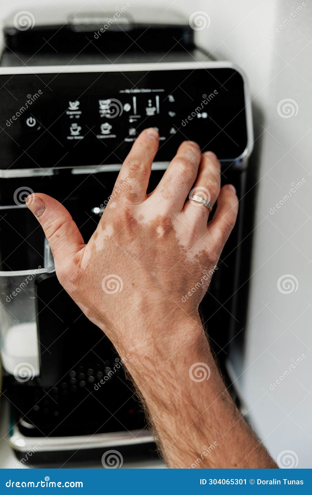 Close Up of a Human Hand with Spots of Vitiligo Disease Operating ...
