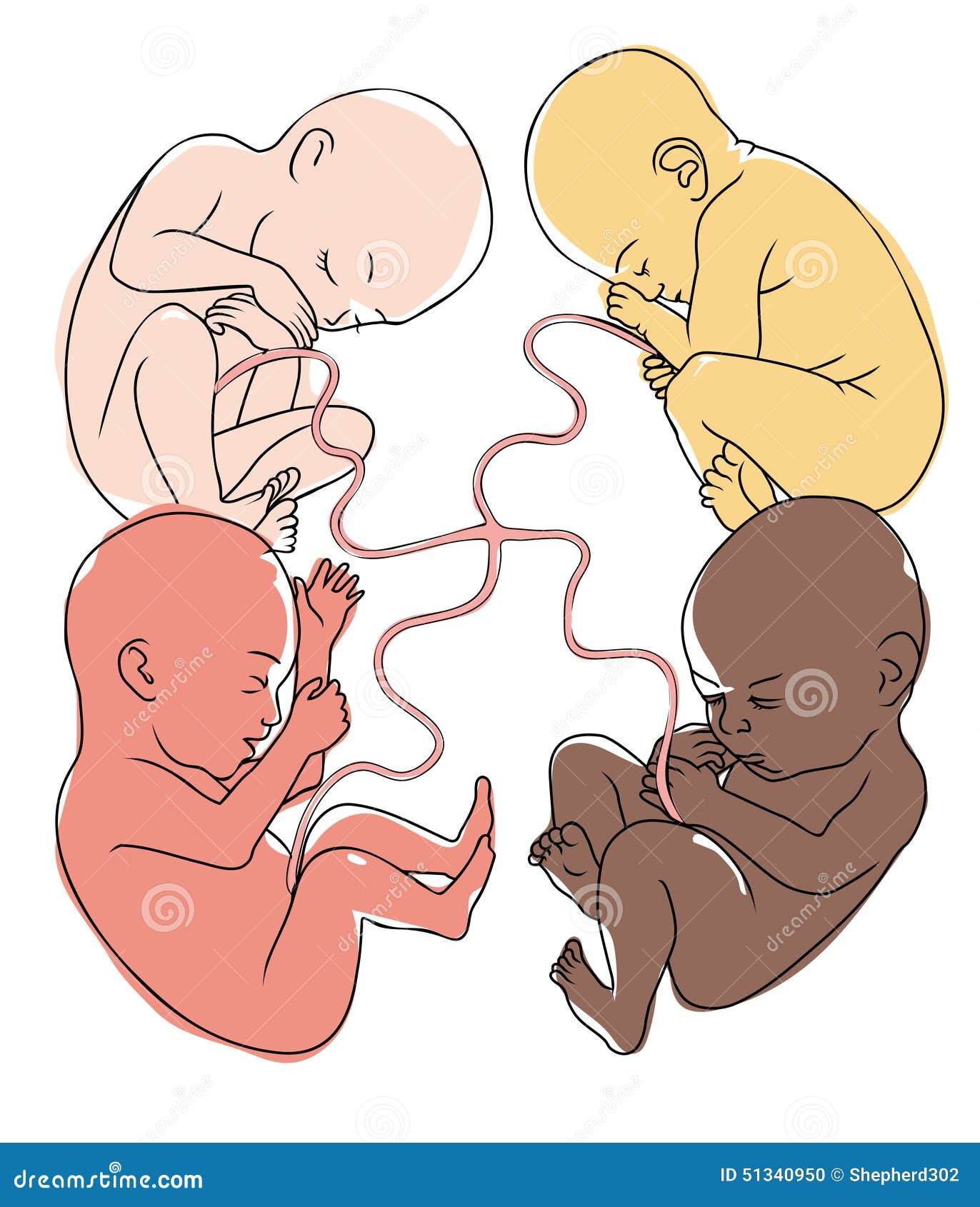Single Umbilical Artery. Anatomy Of Umbilical Cord With One Umbilical ...