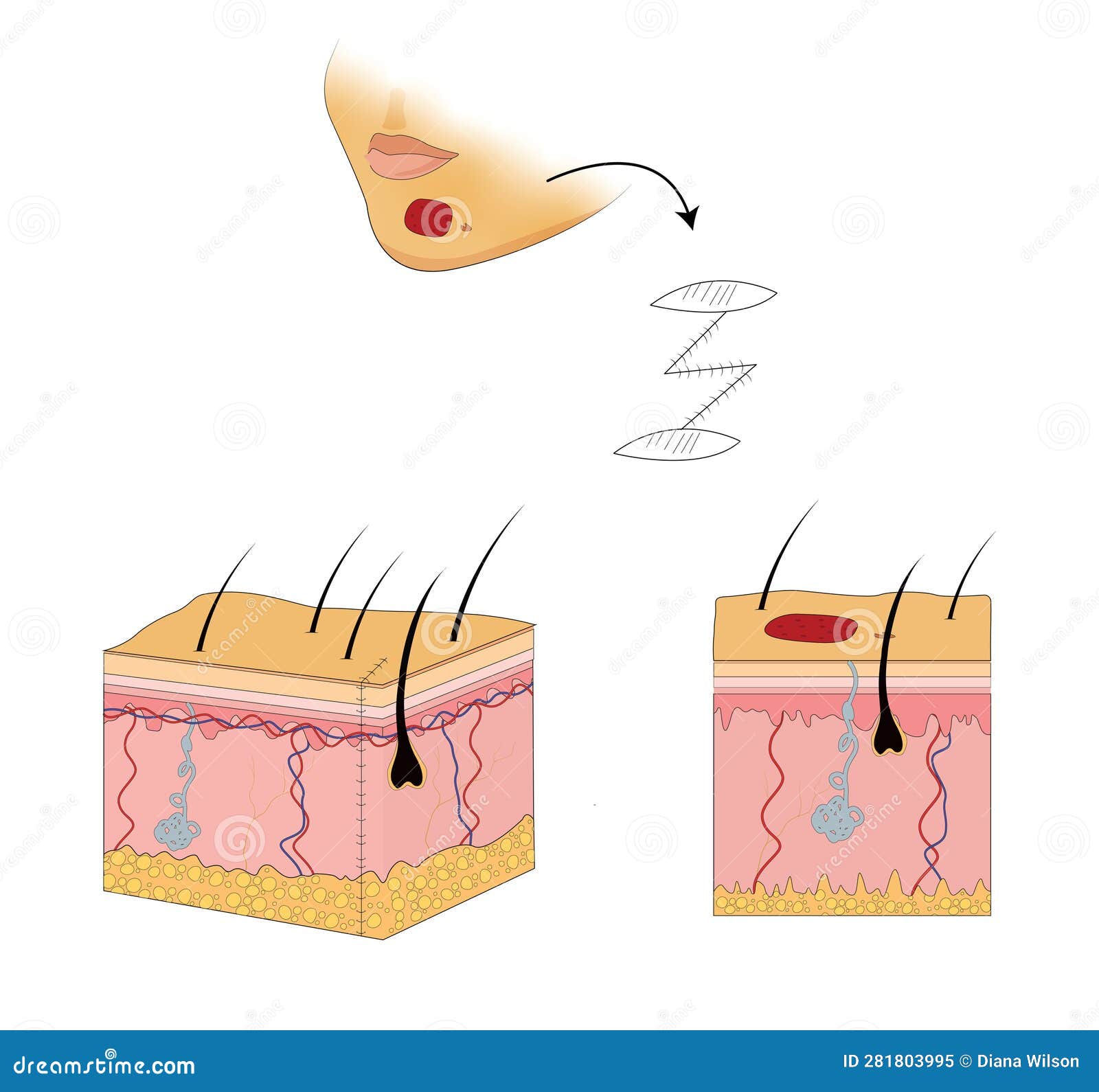 Laceration Suture Icon Cartoon Vector. Injury Skin Cut | CartoonDealer ...