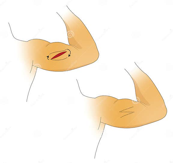 Adjacent Tissue Transfer or Rearrangement, Scalp, Arms and or Legs ...