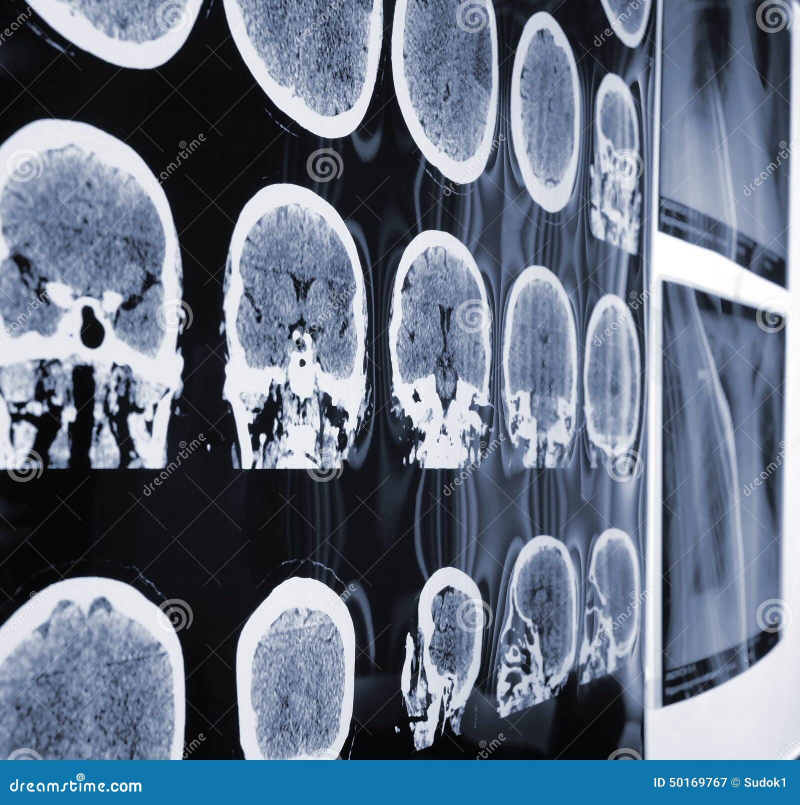 Unusual View of the MRI, X-ray Images of the Patient during Disc Stock ...