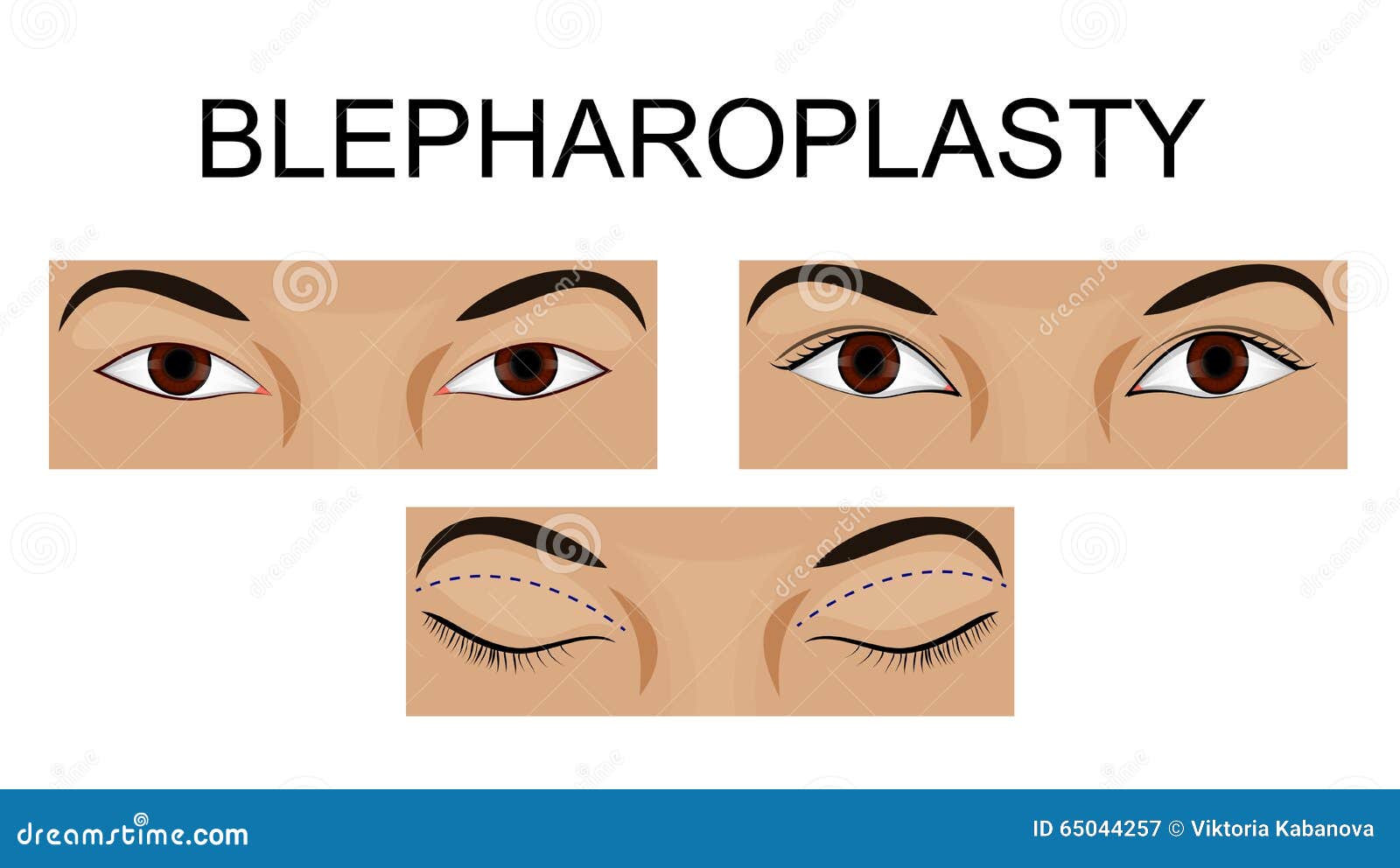 Upper Eyelid Blepharoplasty Stock Vector - Illustration of adjustment ...
