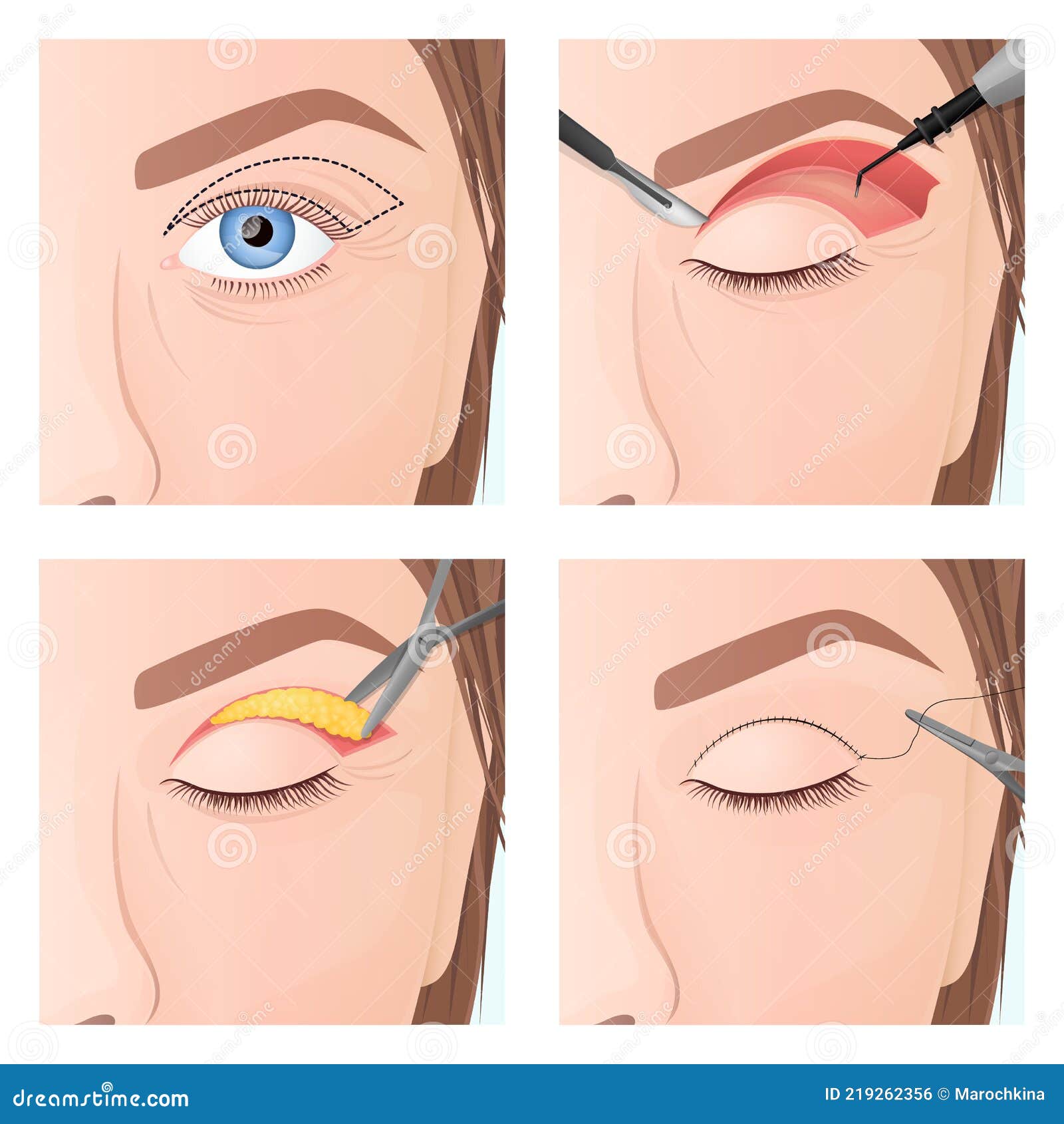Upper Eyelid Plastic Surgery Procedure, Step by Step Process Stock ...