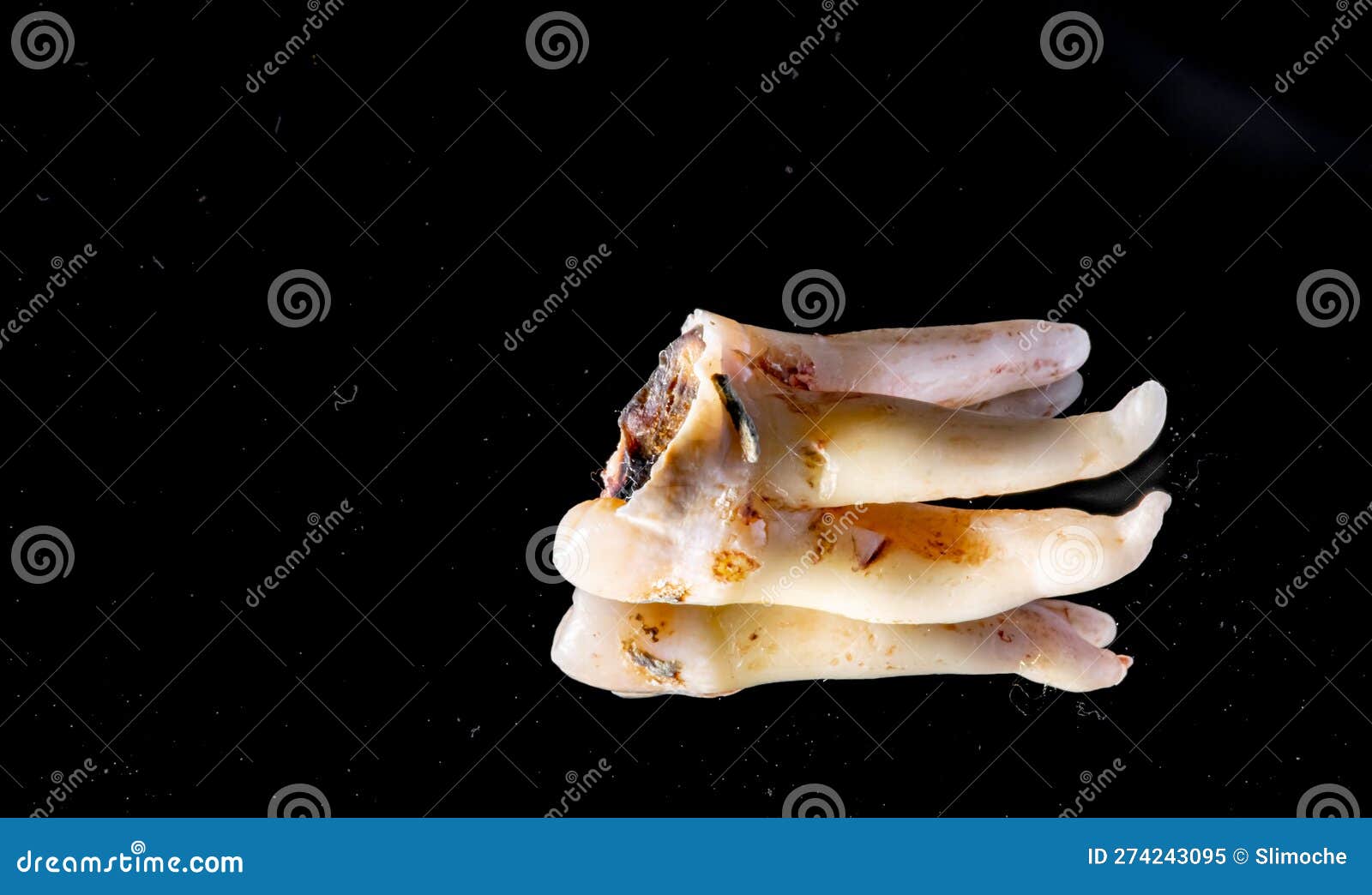 Upper Molar Tooth Completely Destroyed Decayed Crown and Curved Roots ...