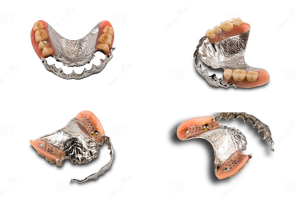 Upper Partial Metal Swinglock Type Denture Stock Image - Image of model ...