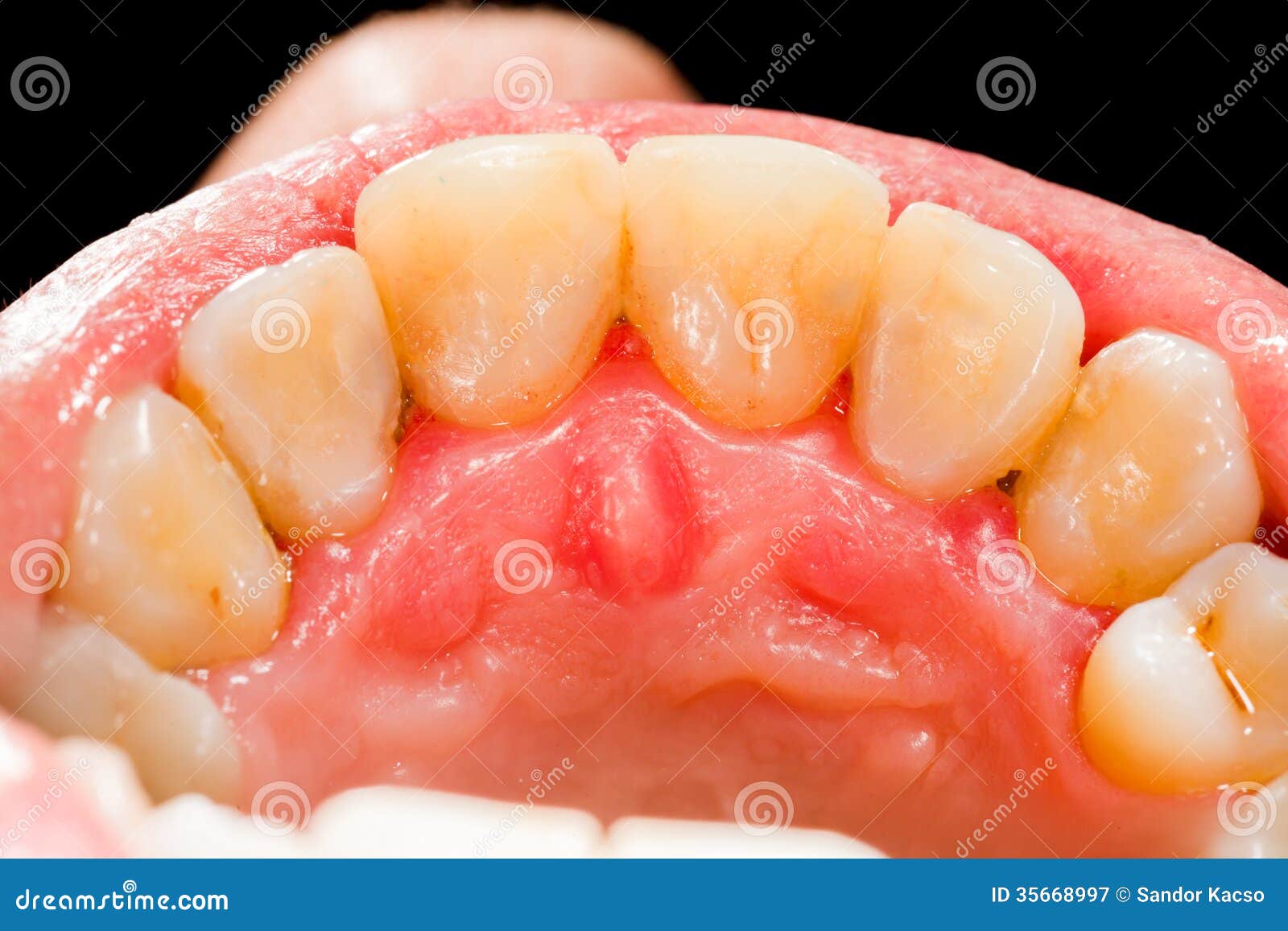 Upper Teeth stock image. Image of health, gingiva, gums - 35668997