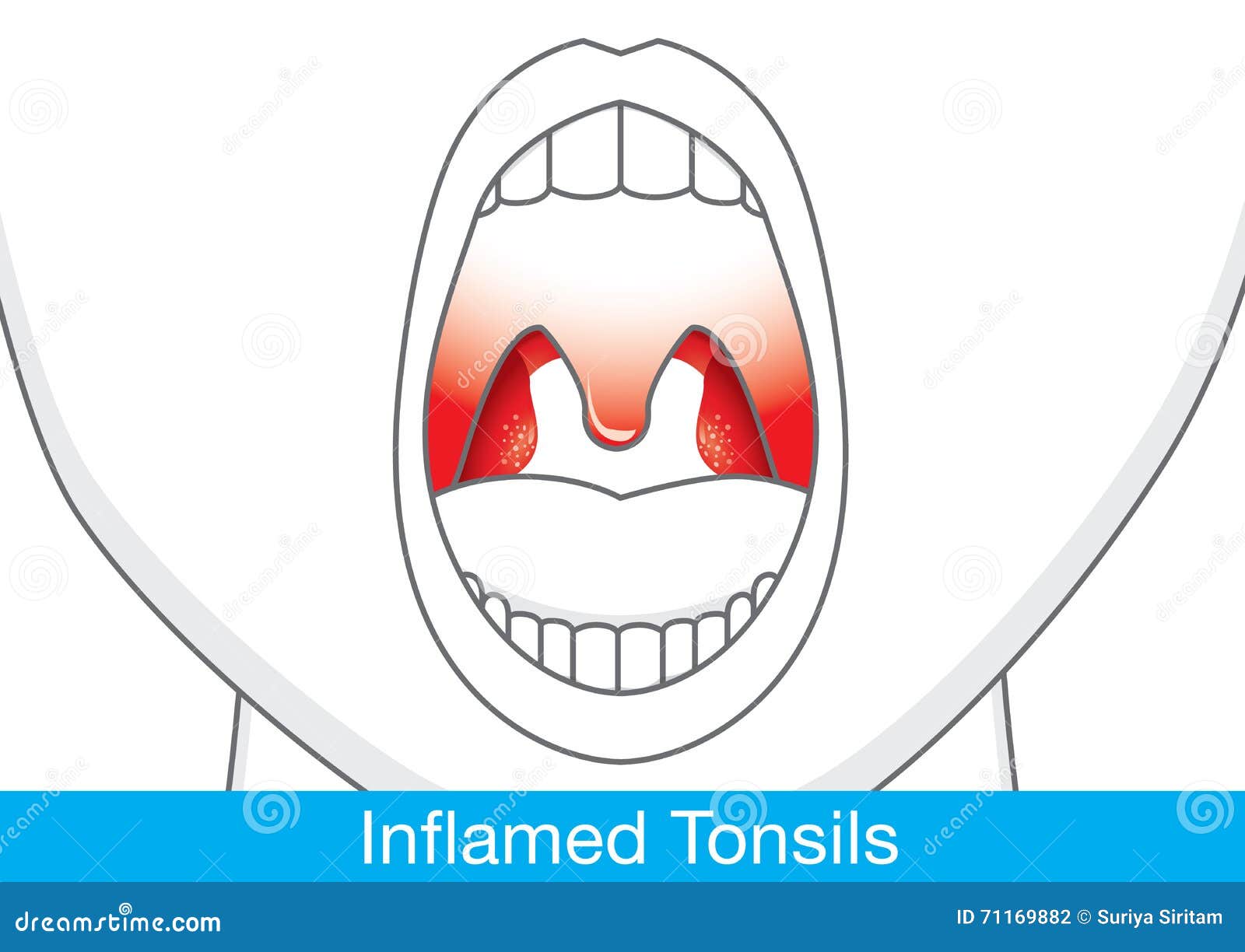 Uppvisning Av Inflammerade Tonsillar Vektor Illustrationer ...