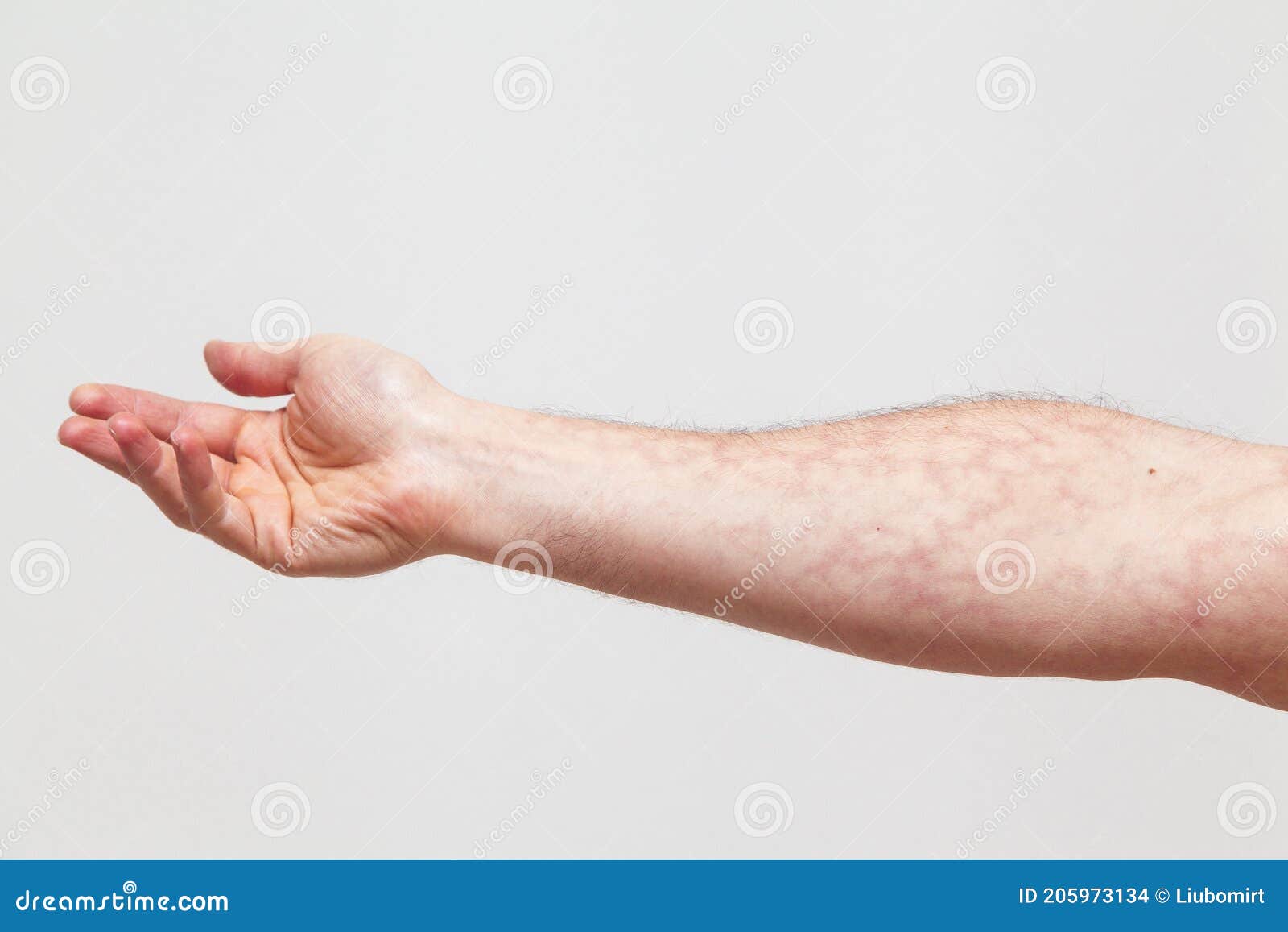 Upright Forearm with Red Skin Capillary Network Stock Photo - Image of ...