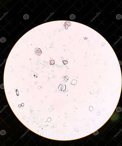 Uric Acid Crystals in Urine Stock Photo - Image of urine, microscopic ...