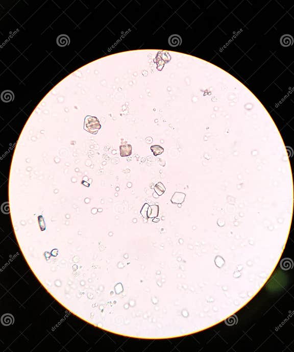 Uric Acid Crystals in Urine Stock Photo - Image of urine, microscopic ...