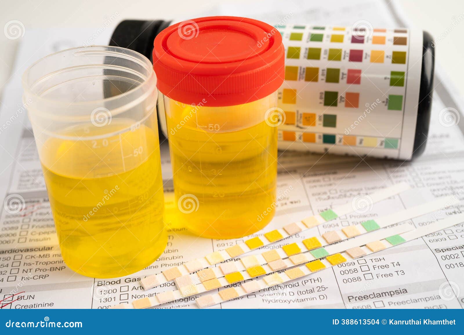 Urinalysis, Urine Cup With Reagent Strip PH Paper Test And Comparison ...