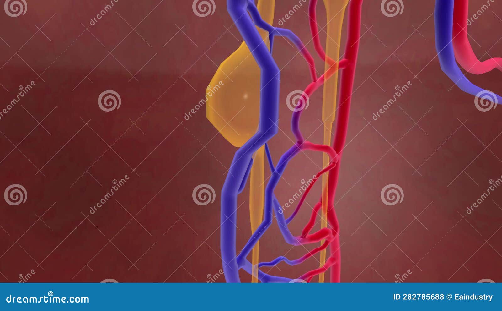 Urinary Stasis Causing Kidney Stones Cyst Stock Footage - Video of ...