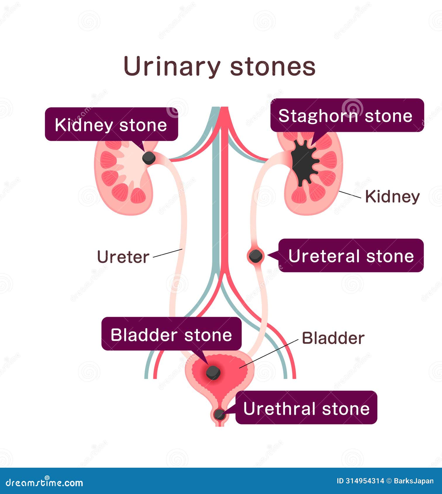 Urinary Stones Anatomy Pain Male Internal Organ Painful Cristaline ...