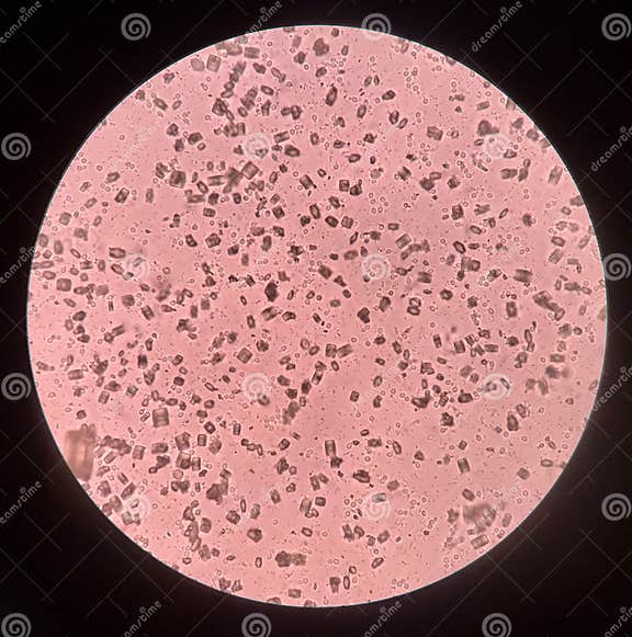 Urine Analysis Finding with Microscope Show Crystal Bacteria and ...