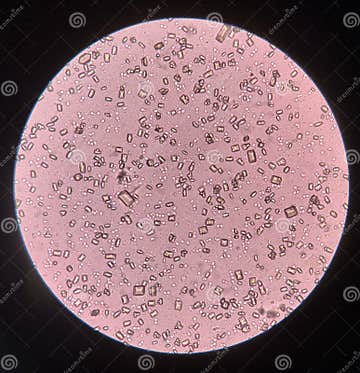 Urine Analysis Finding with Microscope Show Crystal Bacteria and ...