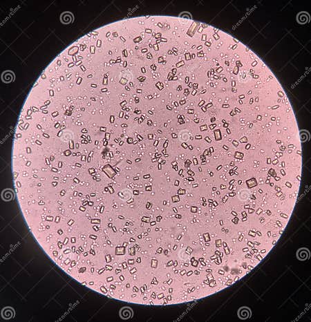 Urine Analysis Finding with Microscope Show Crystal Bacteria and ...