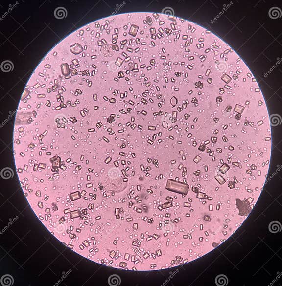 Urine Analysis Finding with Microscope Show Crystal Bacteria and ...