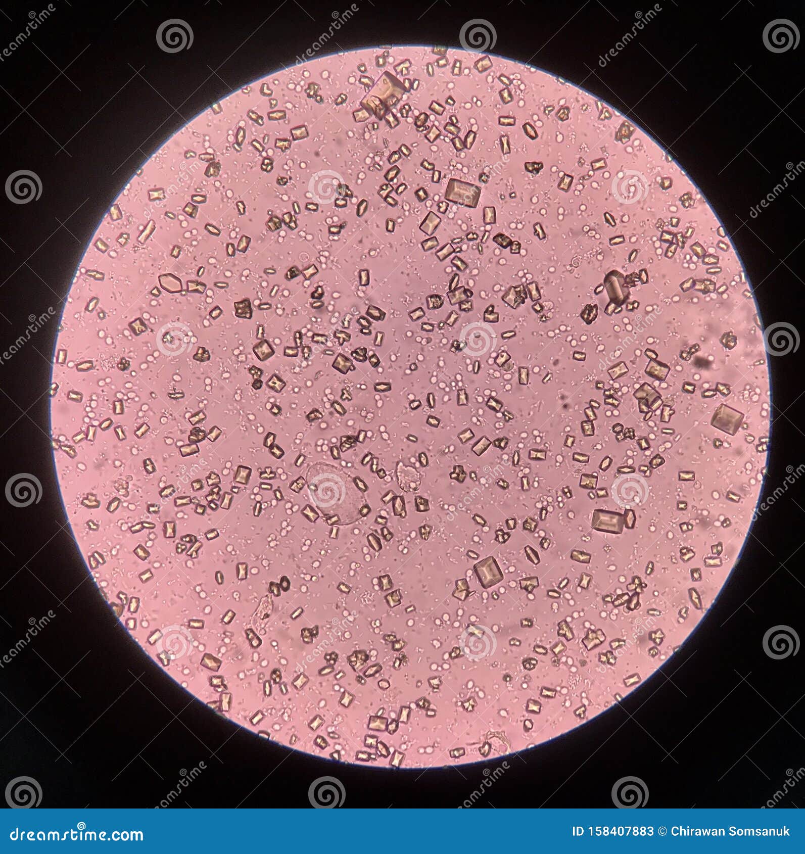 Urine Analysis Finding with Microscope Show Crystal Bacteria and ...