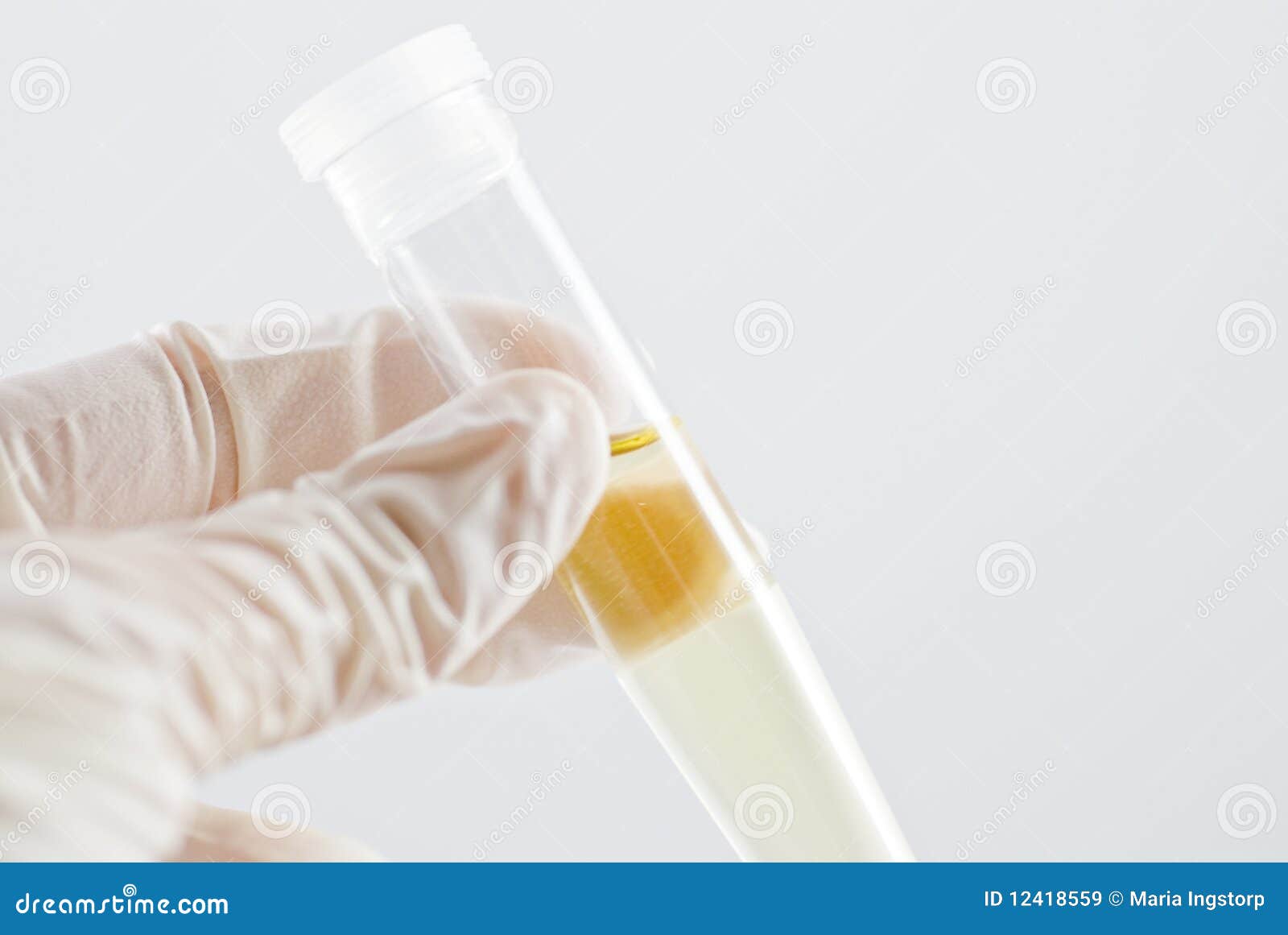 Urine Sample For Urine Microalbumin Test, Urinalysis. CKD Stock Photo ...