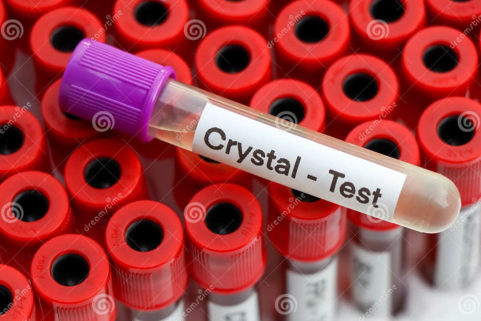 Urine Samples for Testing Crystal in the Laboratory Stock Photo - Image ...