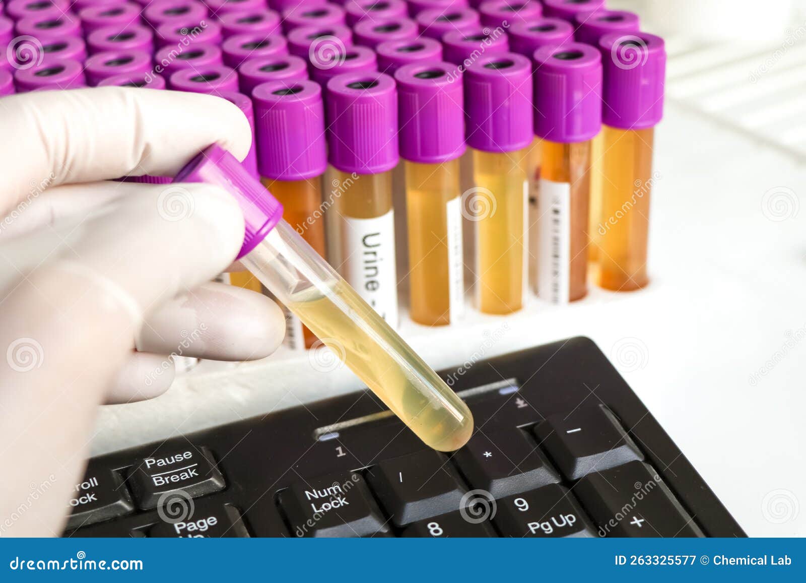 Urine Test To Look for Abnormalities from Urine, Urine Sample To ...