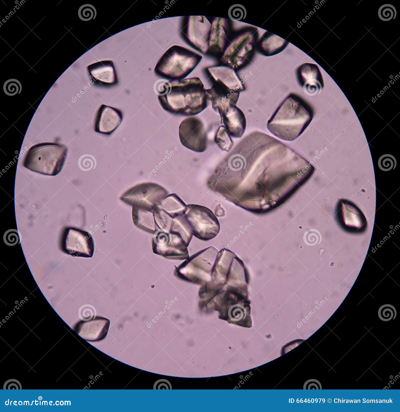 Urinezuur in urinesediment stock afbeelding. Image of besmetting - 66460979