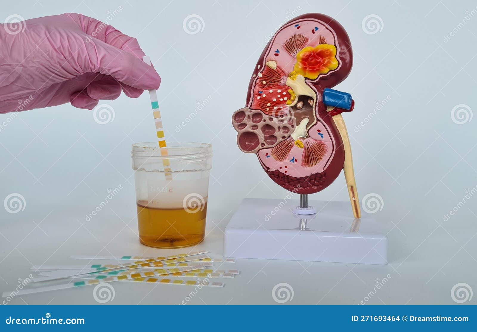 Urologist Doctor Makes Express Analysis of Urine Using Indicator Paper ...