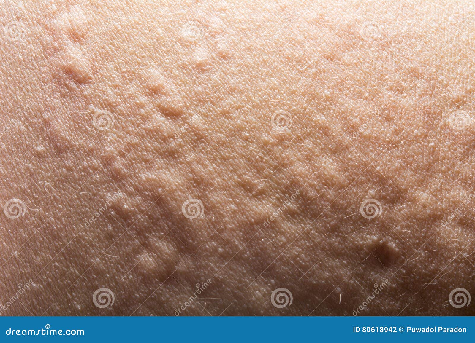 Urticaria or allergy rash stock photo. Image of allergist - 80618942