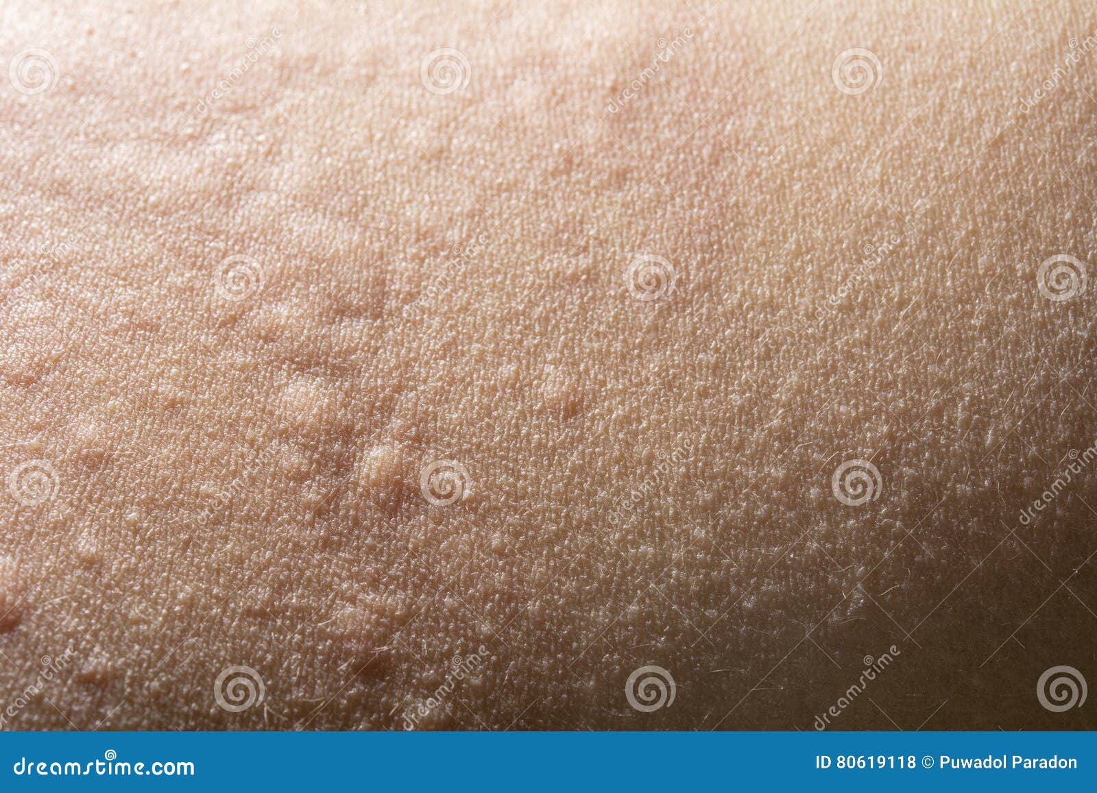 Urticaria Lub Alergii Wysypka Zdjęcie Stock - Obraz złożonej z alergia ...