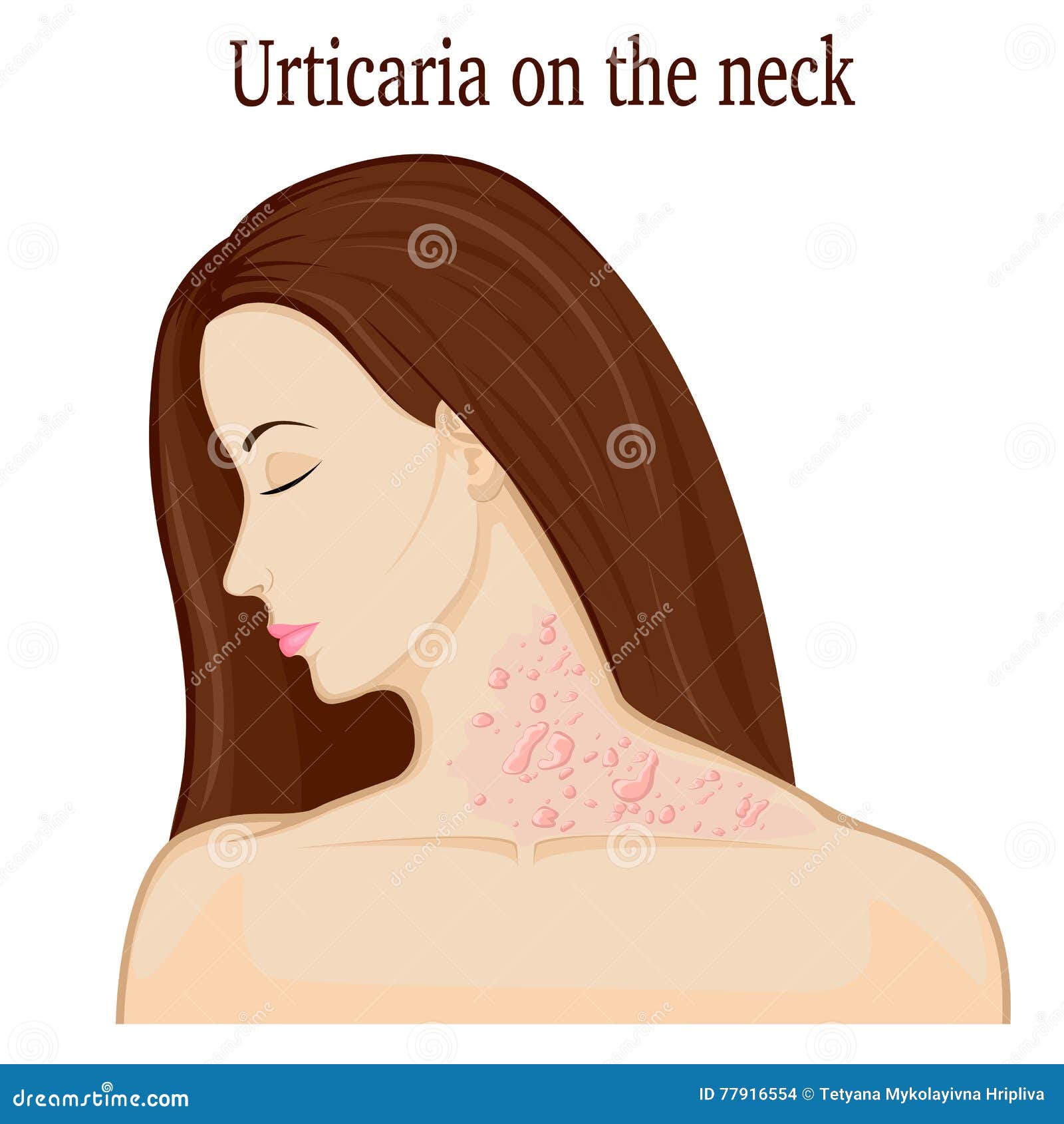 Hives Urticaria Vector Illustration. Labeled Skin Rash Explanation ...