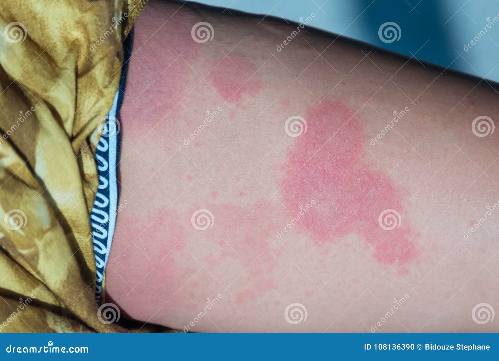 Urticaria on woman leg stock photo. Image of rash, sick - 108136390