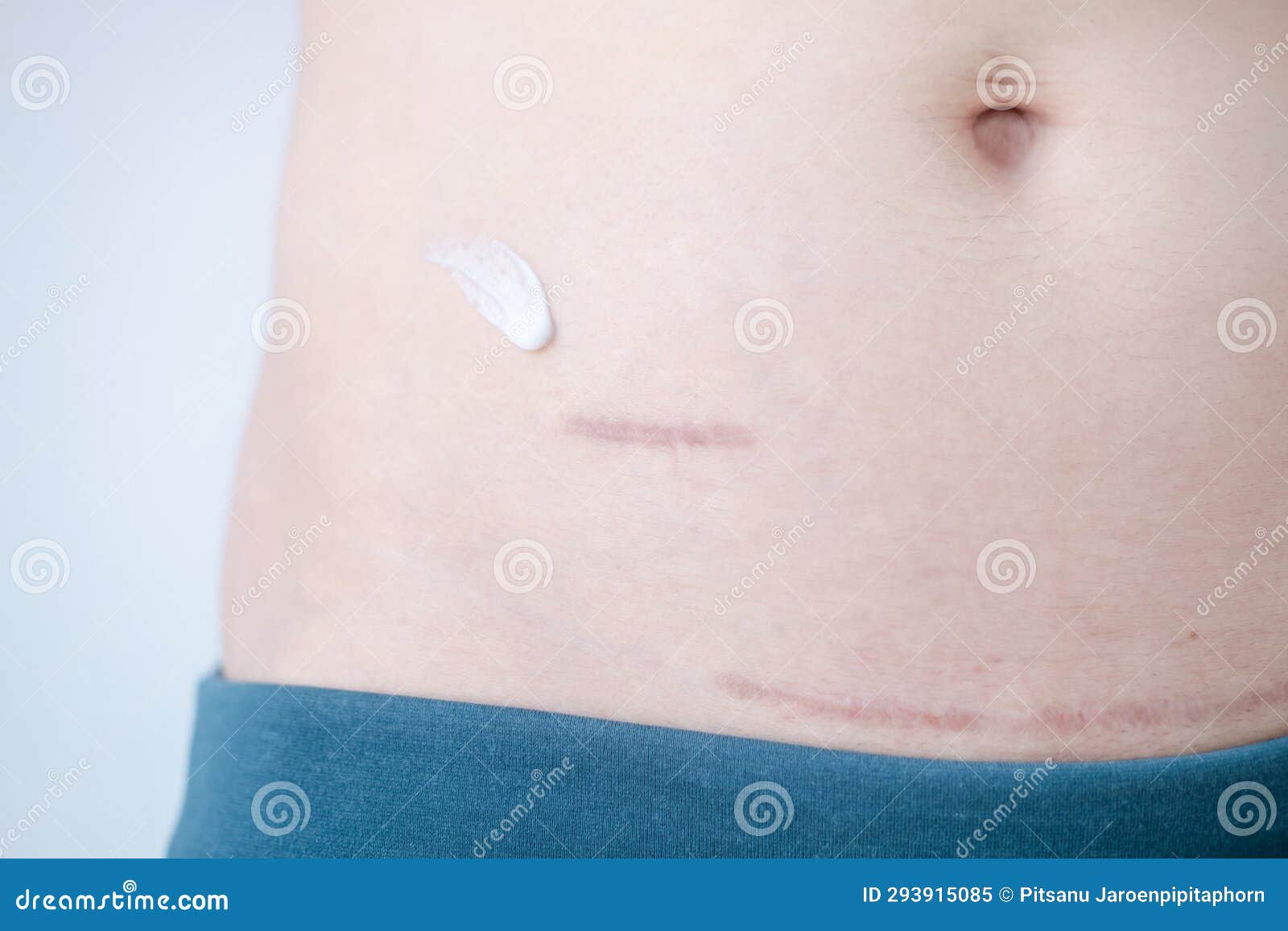 Using Cream To Care for Scars after Appendix Surgery and Postpartum ...