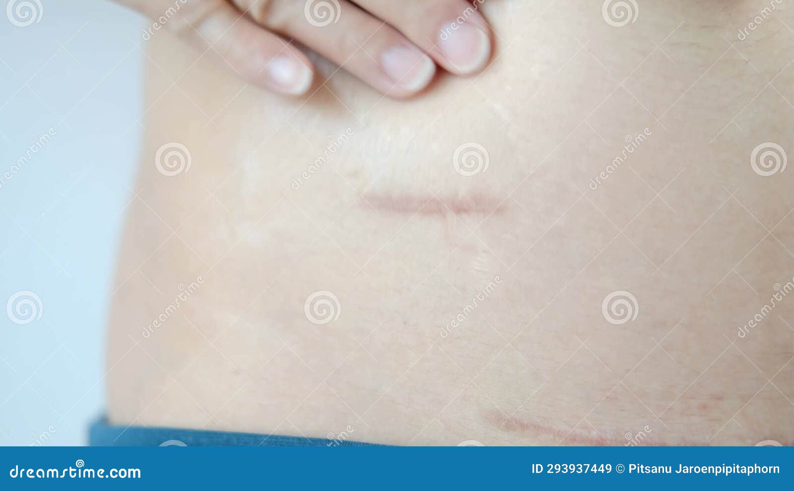 Using Cream To Care for Scars after Appendix Surgery. Stock Video ...