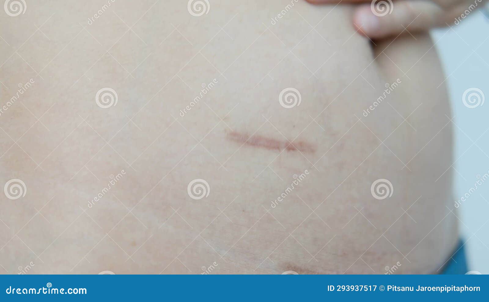 Using Cream To Care for Scars after Appendix Surgery Stock Video ...