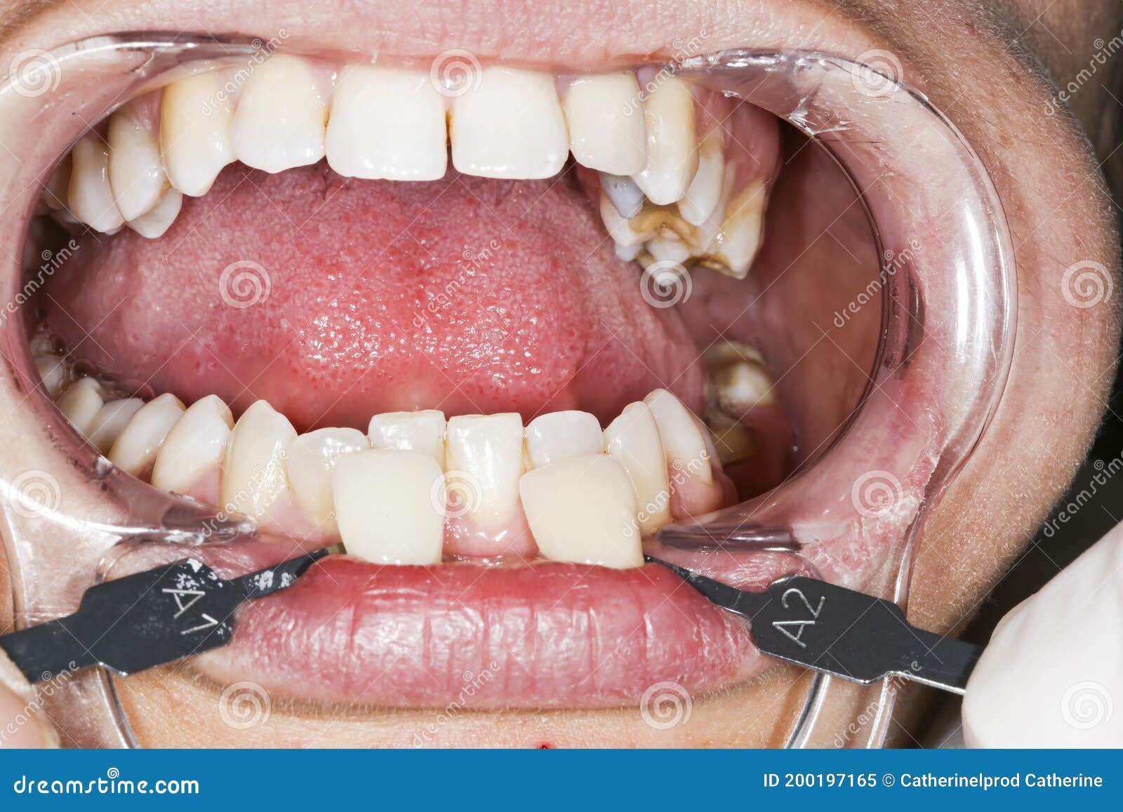 Using a Shade Guide To Check Veneer of Tooth Crown Stock Image - Image ...