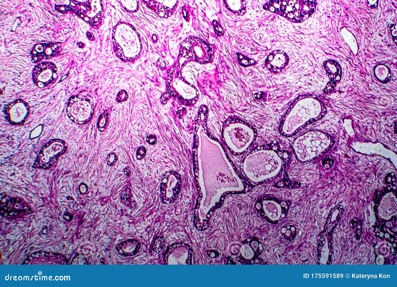 Uterine Cancer, Light Micrograph Stock Image - Image of microscopy ...