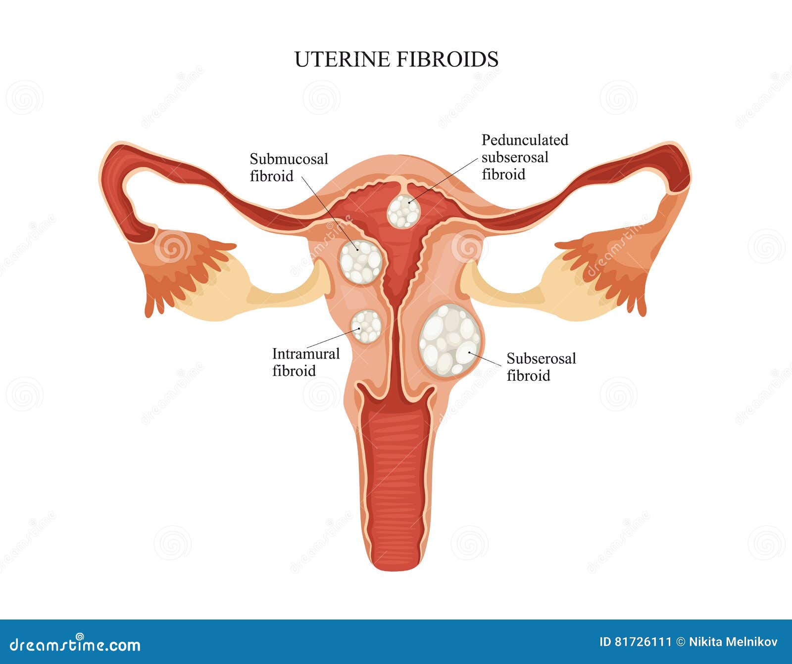 Uterine Fibroid Stock Vector Illustration Of Problem 81726111