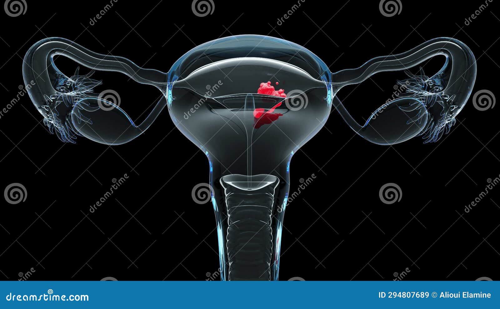 Uterus Malignant Tumor Female Uterus Anatomy Reproductive System