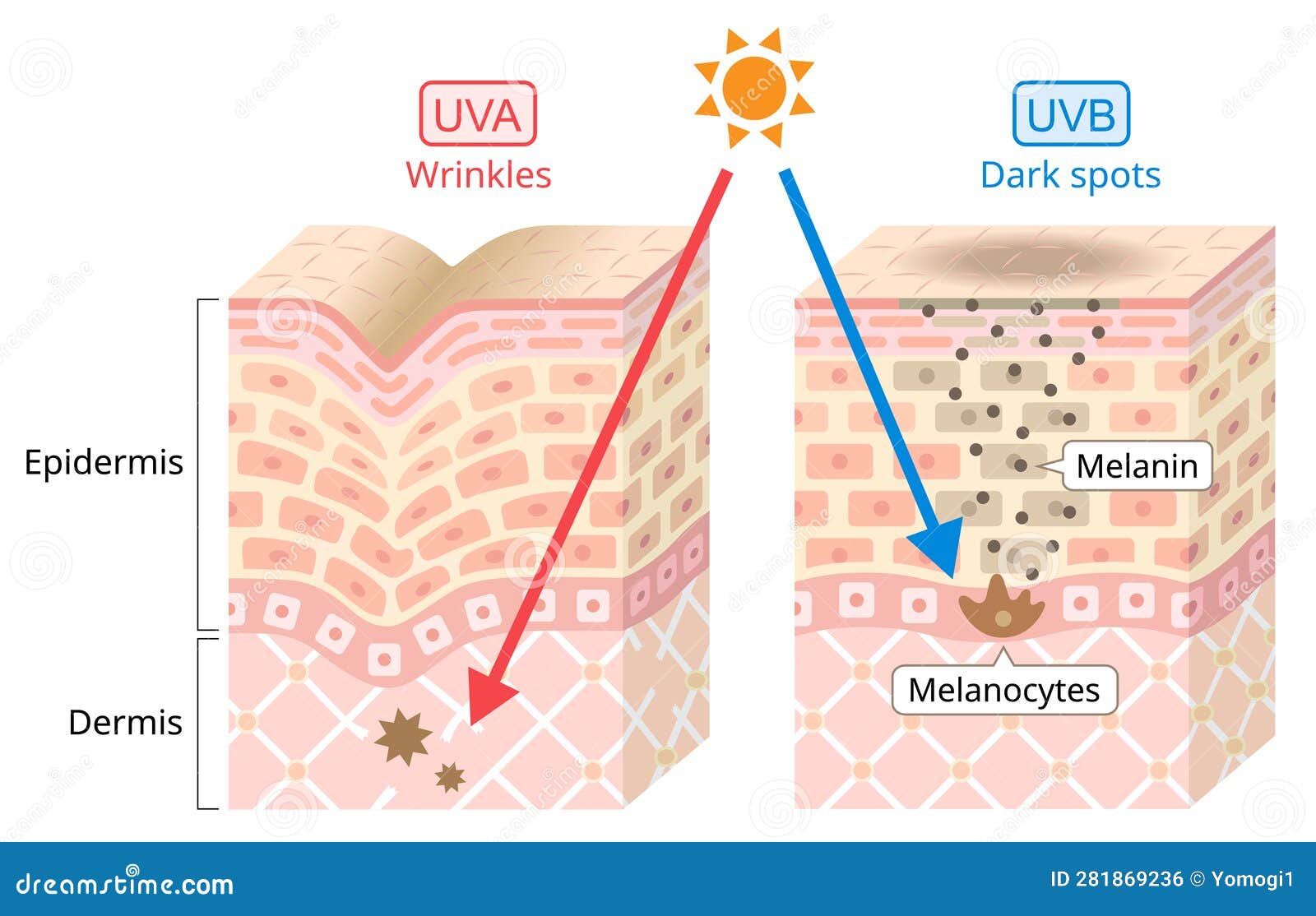 Man With Skin Sunburns Funny Summer Burns On Body After Sunbath Sun