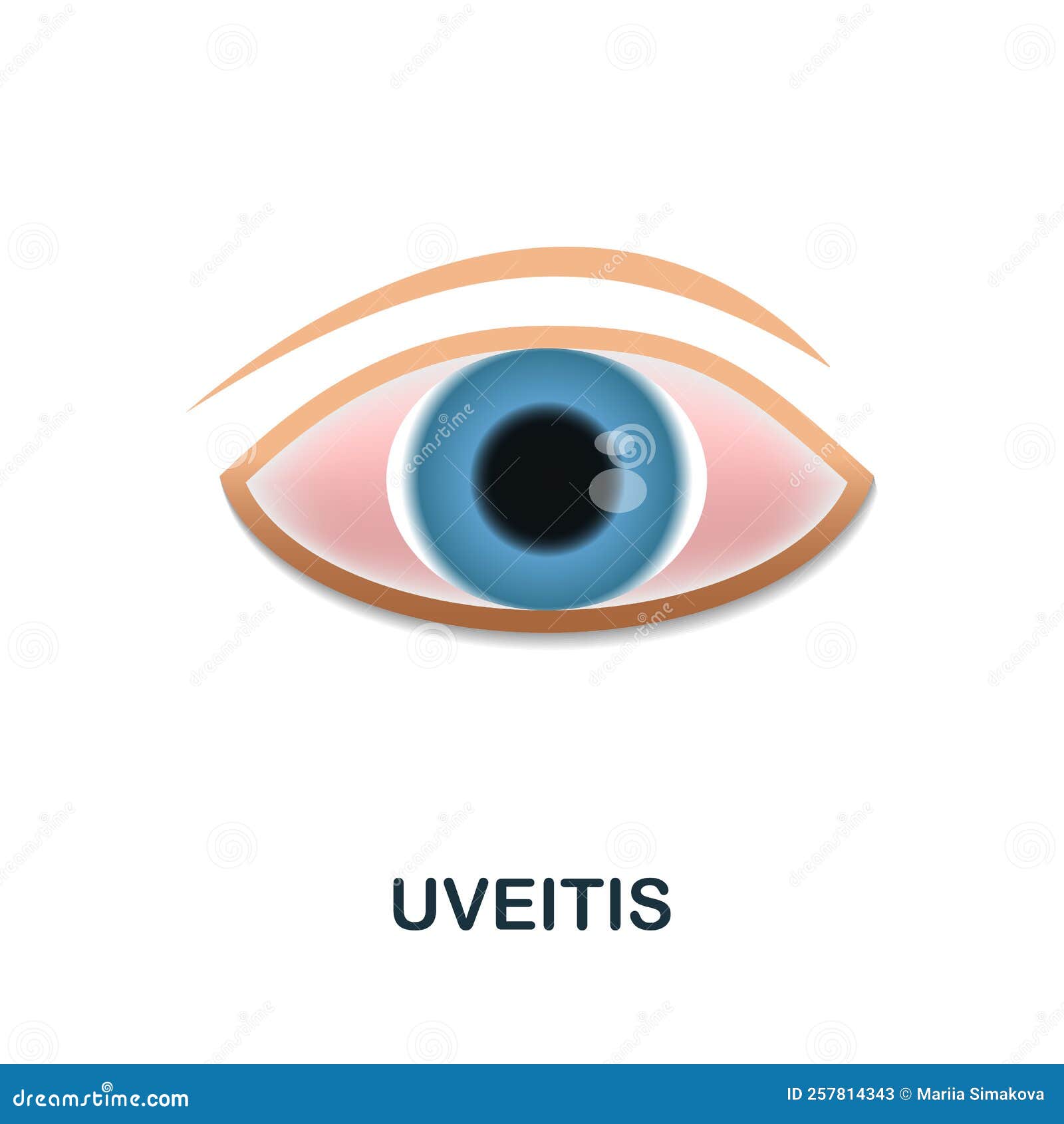 Uveitis