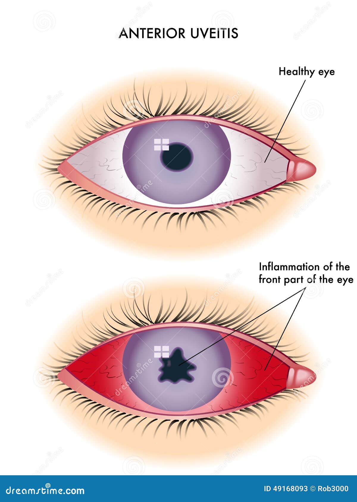 Uveitis Symptoms