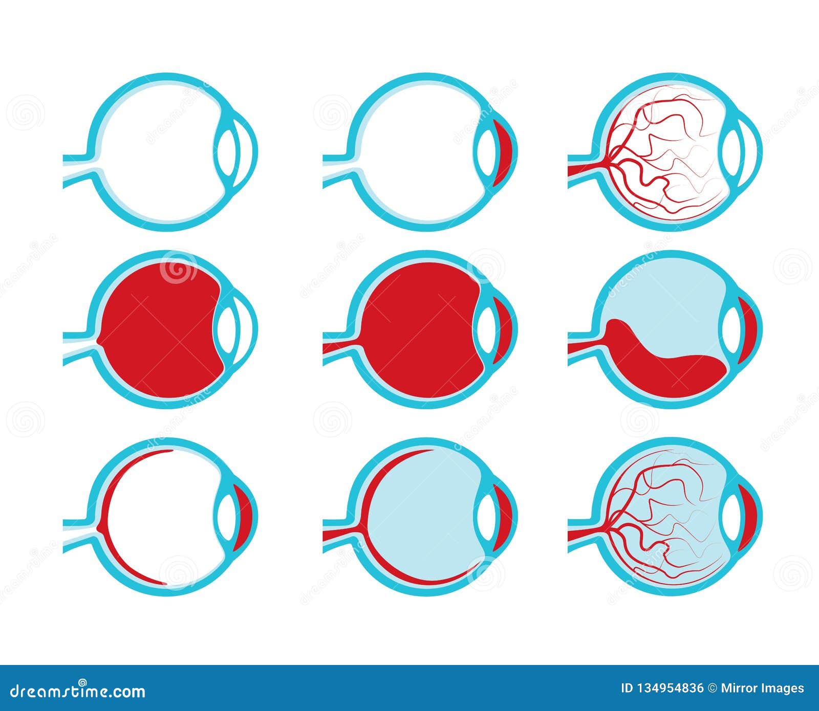 Anatomy Of Normal Eye And Diabetic Retinopathy. Cartoon Vector ...